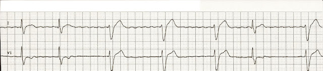 EKG Rhythm Strips 23: Paced Rhythms