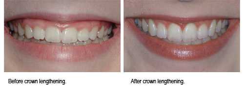 Omni Dental Group Crown Lengthening For A Better Smile Omni Dental Group Crown Lengthening For A Better Smile