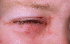 Cara Mengobati Herpes Atau Dompo