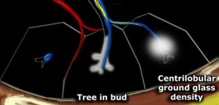 Chest Medicine Made Easy-Dr Deepu: BASICS OF HRCT INTERPRETATION-PART 3 ...
