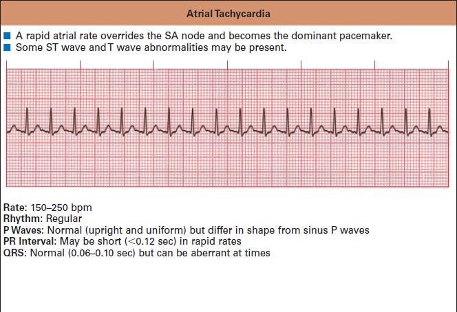 ATRIAL TACHYCARDIA