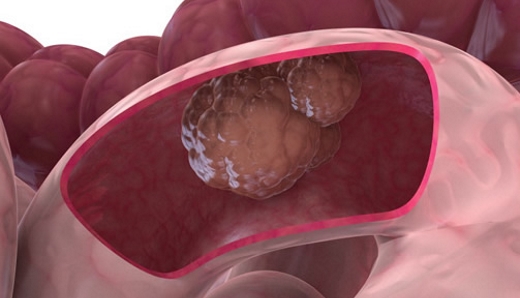 Cáncer de colon: lo que debes saber | Web Salud
