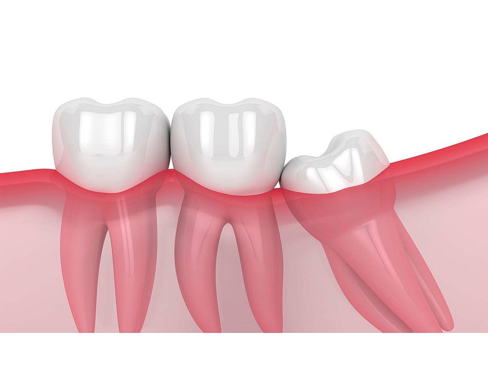 THIRD MOLARS: To extract or not to extract? - OdontoVida