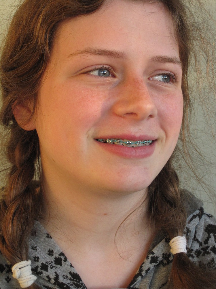 Braces Girl Emily at Susan Lebrun blog