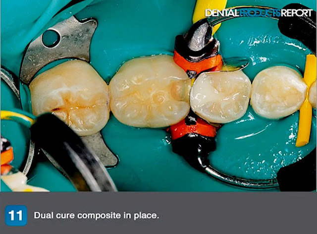 POSTERIOR COMPOSITE RESTORATION: Efficiently place posterior direct ...