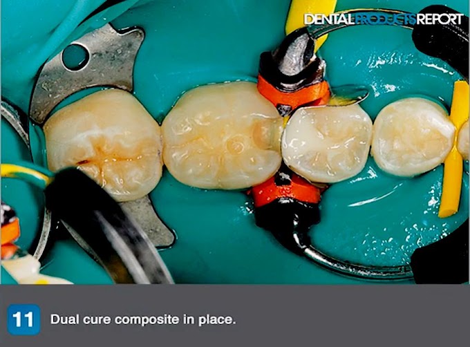 POSTERIOR RESTORATIVE: Simplified posterior direct resin composites