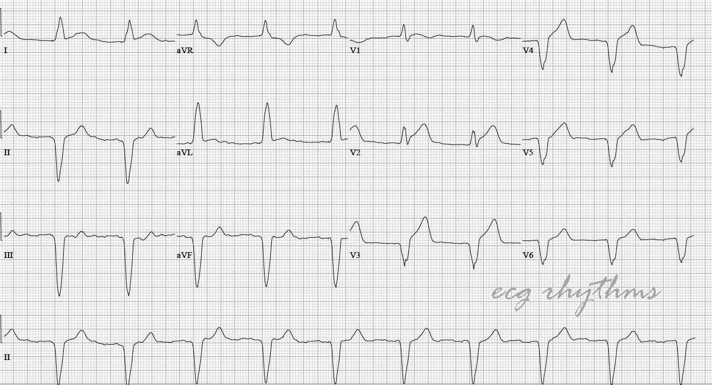 ECG Rhythms: MI in Paced Rhythm