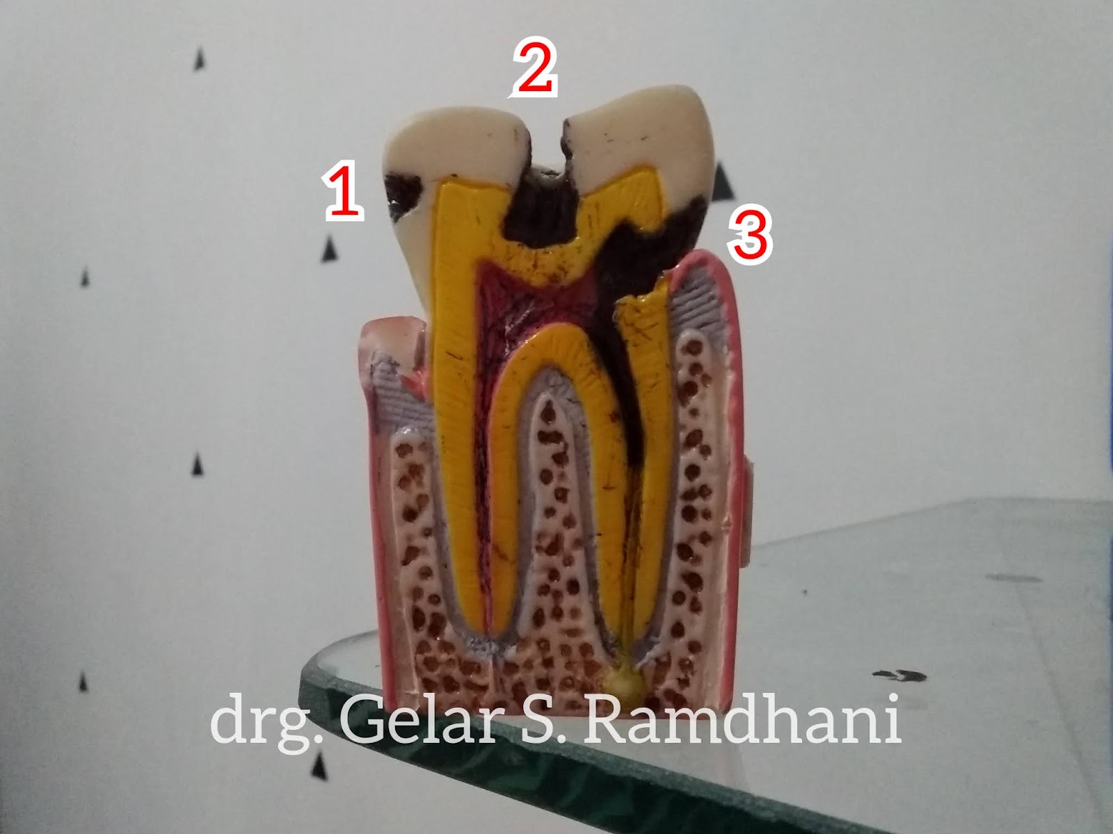 Apa Itu Perawatan Saluran Akar (PSA)?