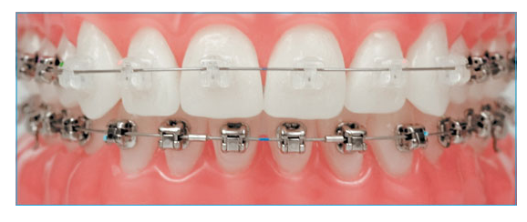 Poser Orthodontics Blog: What is the Damon System?