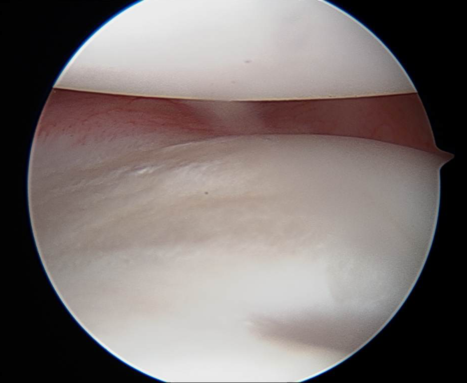Shoulder and Elbow Surgery: Posterior chondrolabral cleft and recurrent ...