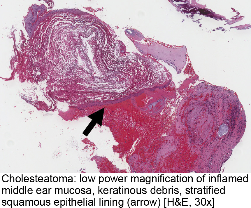 EXAMS AND ME : Cholesteatoma