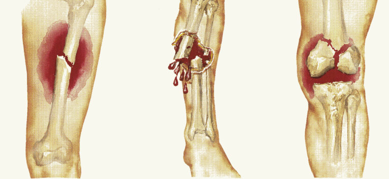 Patah tulang, apa perlu anda lakukan?