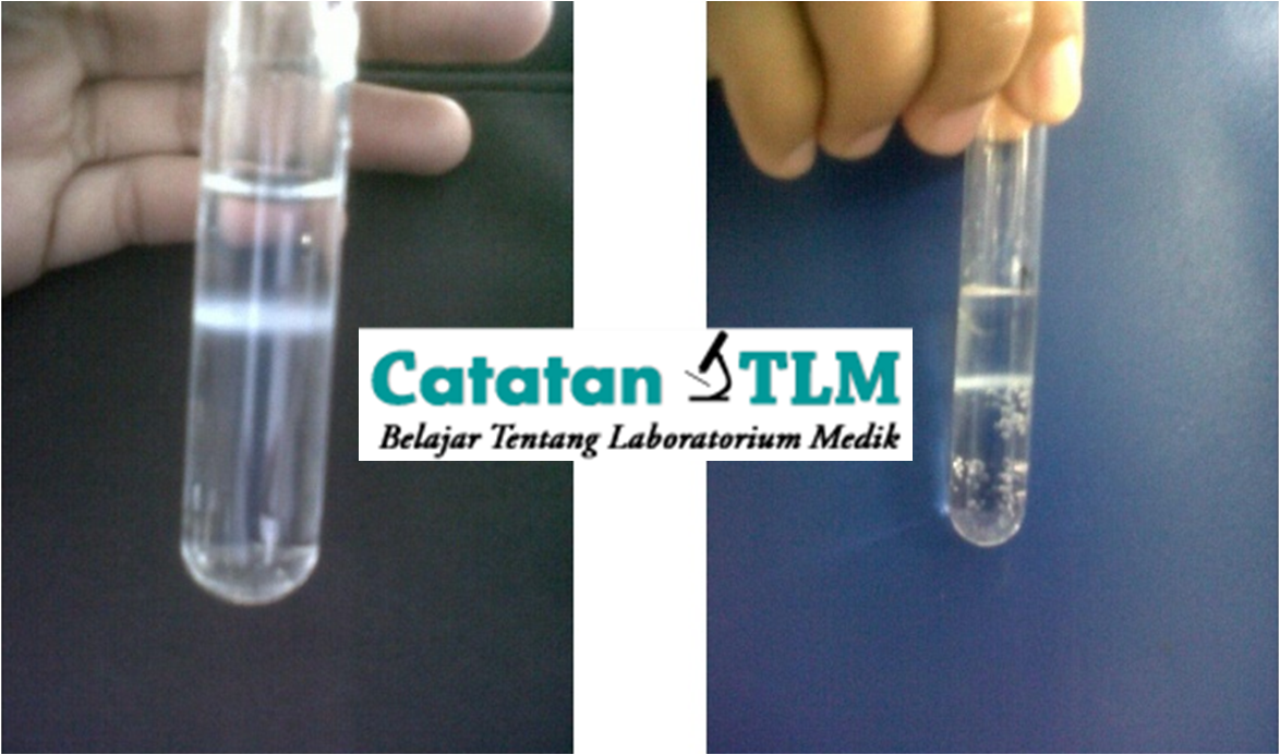 Pemeriksaan Cairan Otak (Nonne dan Pandy)