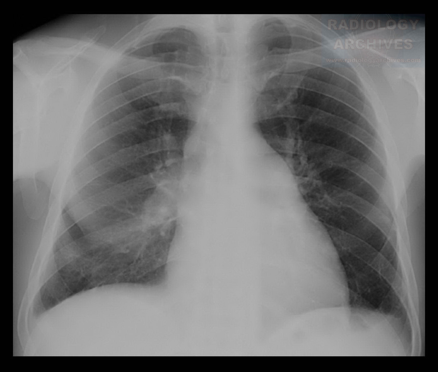 Radiology Archives: Πνευμονική Εμβολή (Σημείο Westermark)