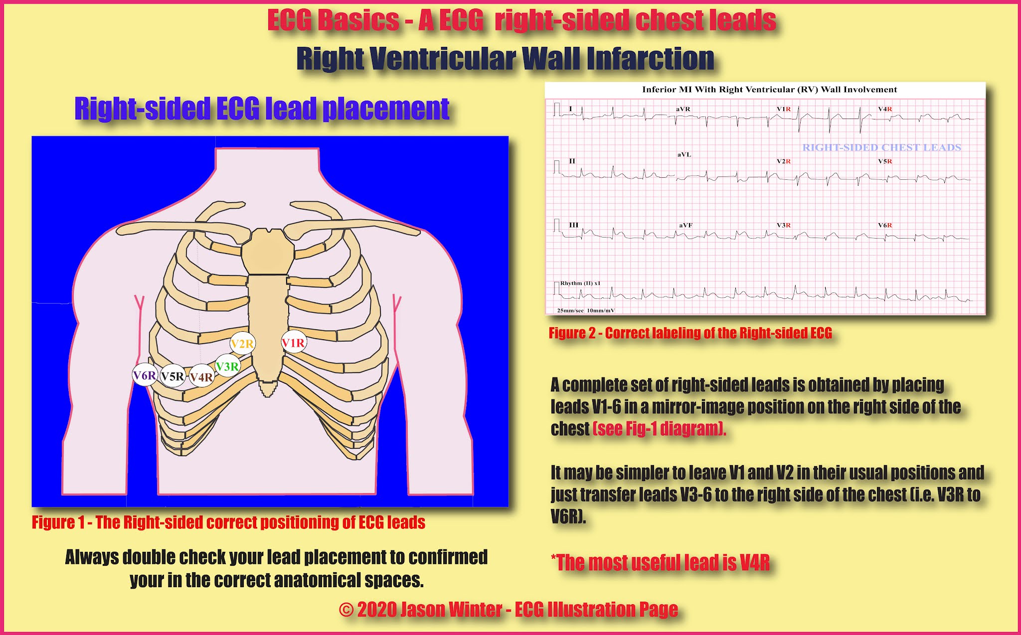 ECG Educator Blog : Right ventricular wall infarction