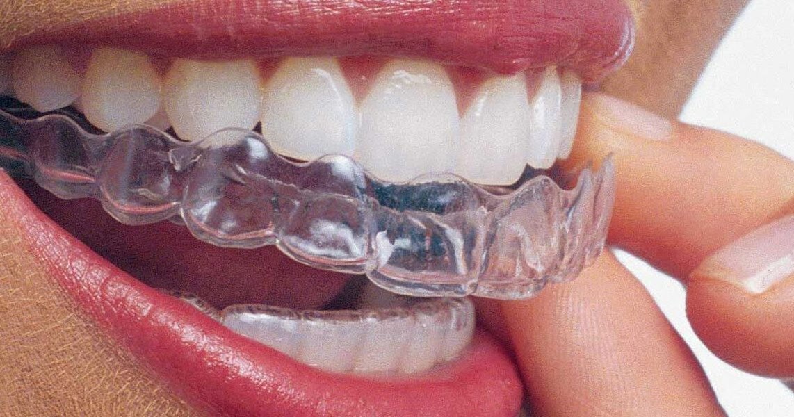 WHY INVISALIGN CLEAR BRACES IS THE BEST?