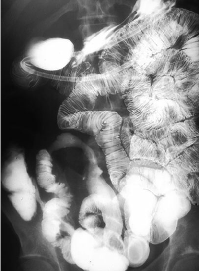 Hello USA: enteroclysis