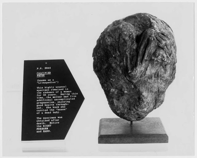 What is a Stone Baby? - summerhill STUDIO | stories