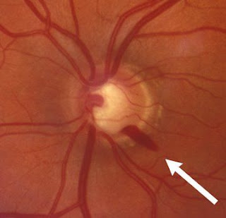 GLAUCOMA SPECIALIST BLOG: "THE GLOG": RETINAL HEMORRHAGES: ARTICLE ON ...