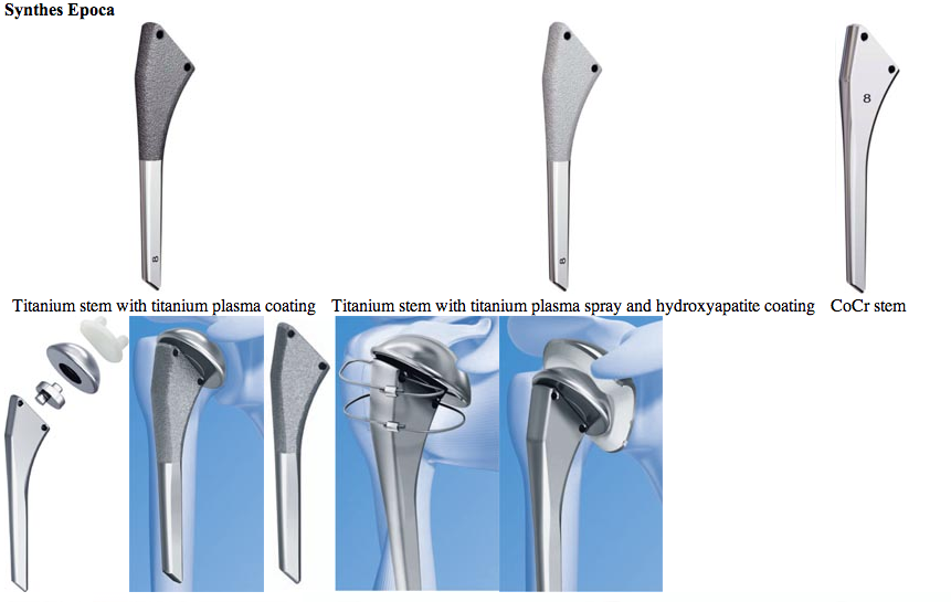 Shoulder and Elbow Surgery: Identifying the implanted shoulder ...
