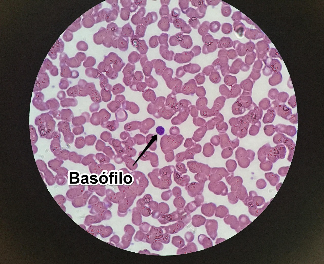 HISTOLOGIA90: MORFOLOGIA DAS CÉLULAS DO SANGUE E LEUCEMIAS