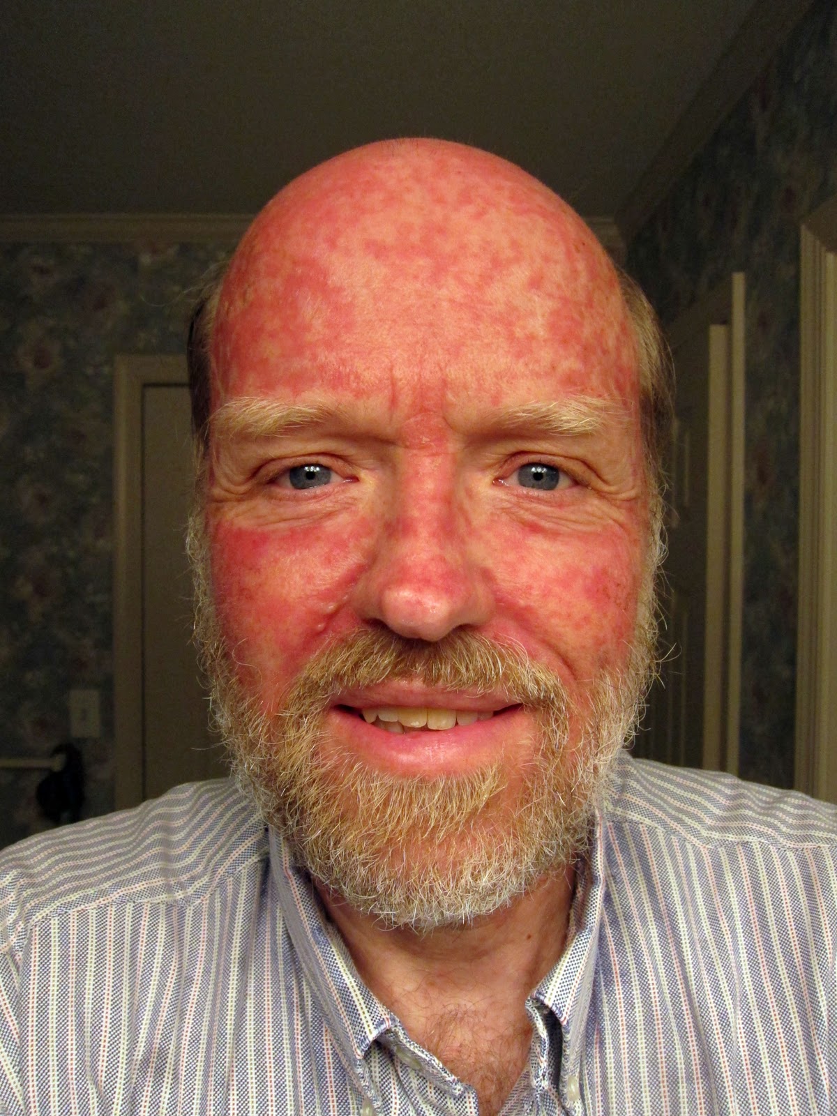 Efudex - Round Two: Day 20 (Recovery Day 6)