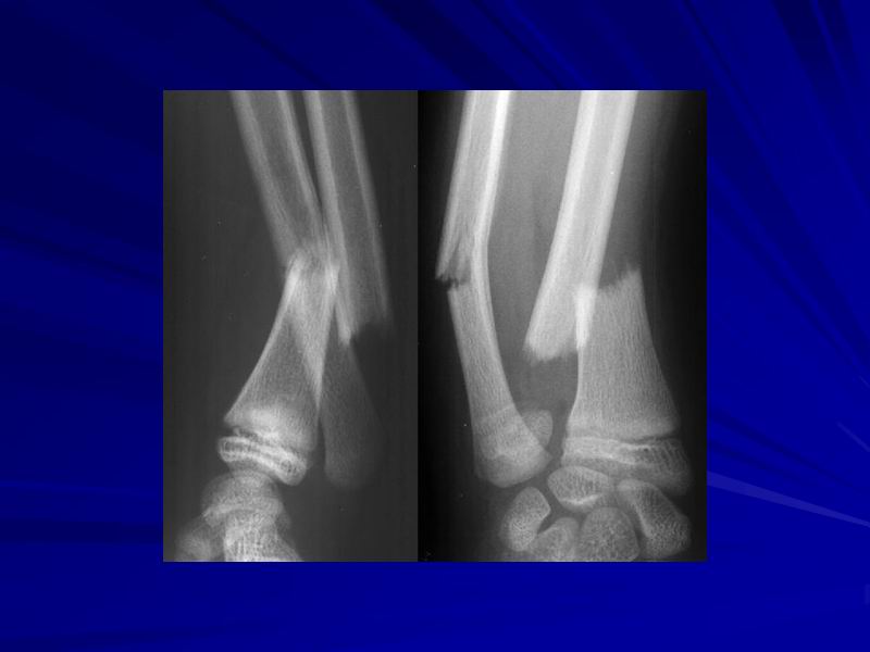 TRAUMATOLOGIA EN ATENCION PRIMARIA: URGENCIAS -FRACTURAS