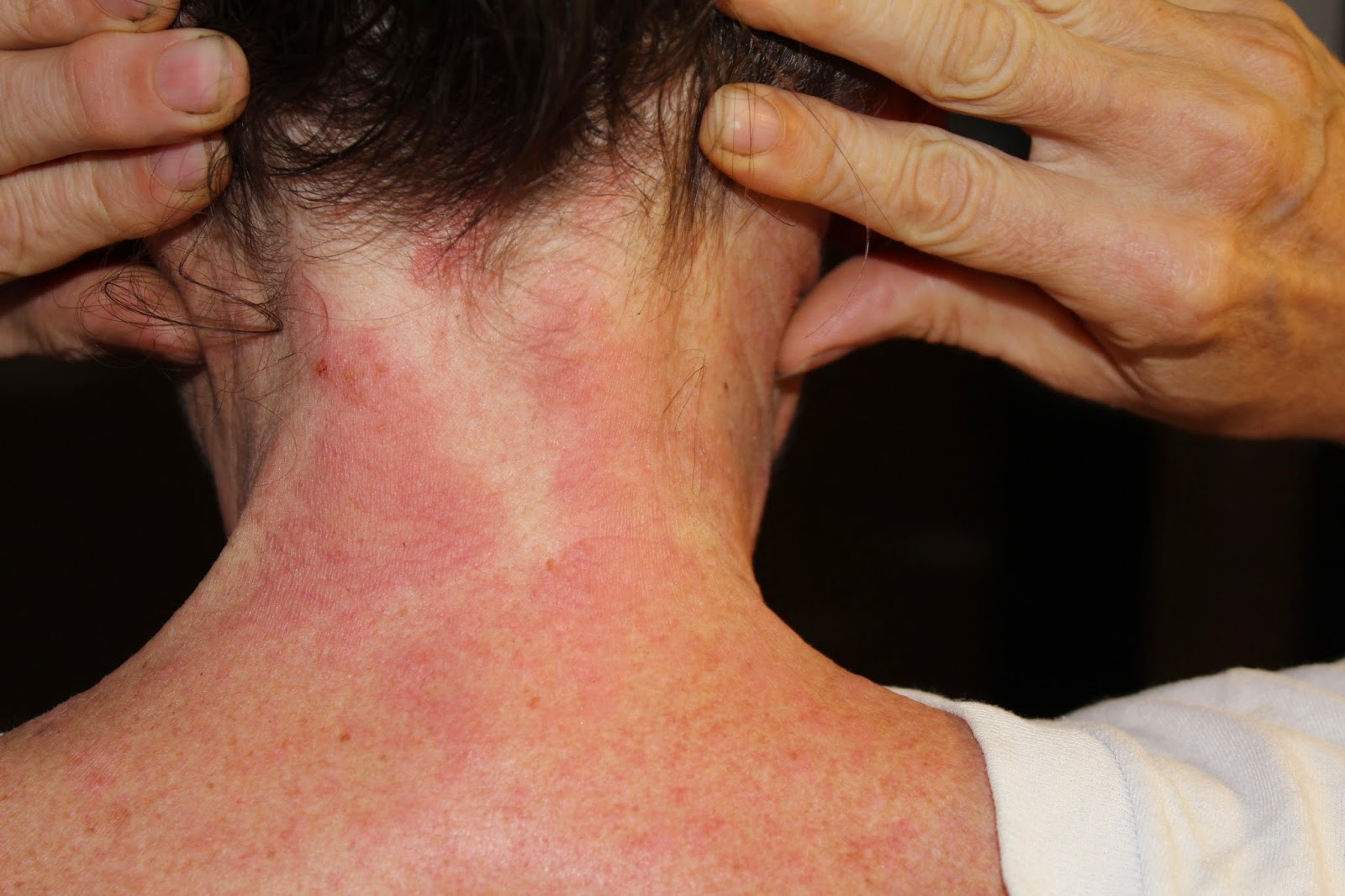 Healing My Asthma/COPD Scarred Lungs