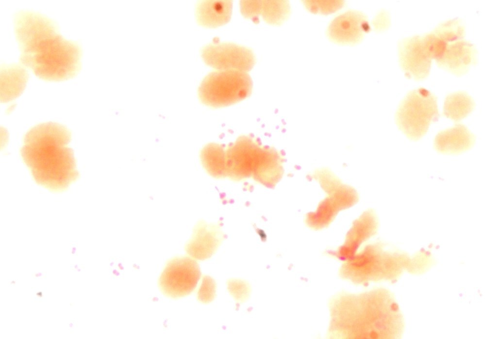 Non-gonococcal Urethritis - Urethritis Cure