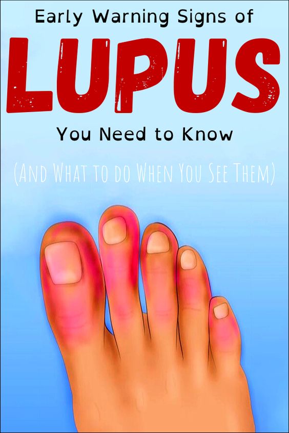 Early Warning Signs of Lupus You Need to Know (And What to Do When You ...