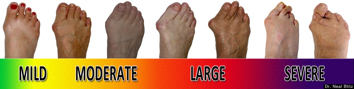 Types Of Bunions - Bunion : What You Need To Know About Bunions