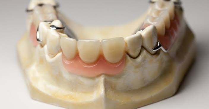 Keberhasilan dan Kegagalan Gigi Tiruan Sebagian Lepasan (GTSL)