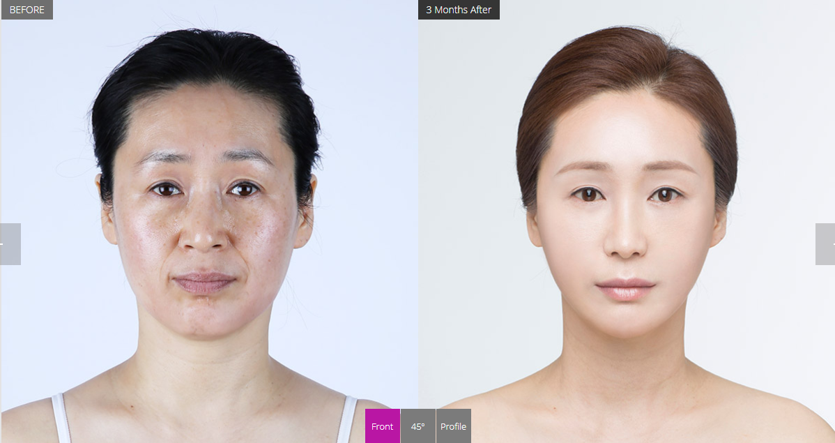 Plastic Surgery in Korea : Endotine Forehead Lifting Surgery, the ...