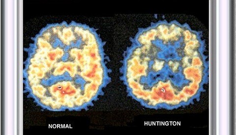 Enfermeria por casa: ENFERMEDAD DE HUNTINGTON