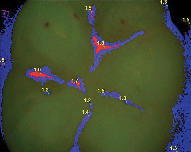 Crescent Dental on Blogspot!: Spectra Caries Detection