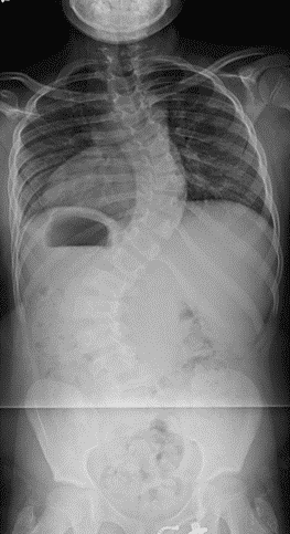 The Shilla Growth Guidance Procedure | Growing Spine Blog | Washington ...