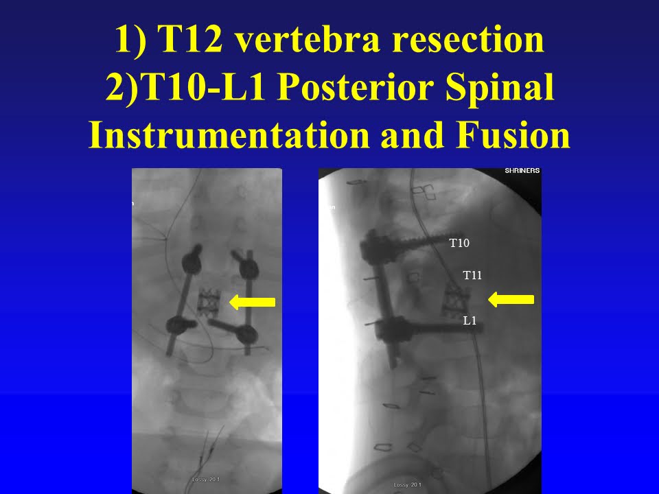 Congenital Spine Dislocation | Growing Spine Blog | Washington ...