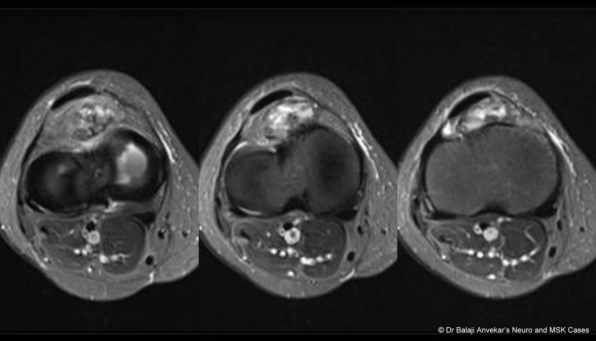 Dr Balaji Anvekar FRCR: GCT of tendon sheath