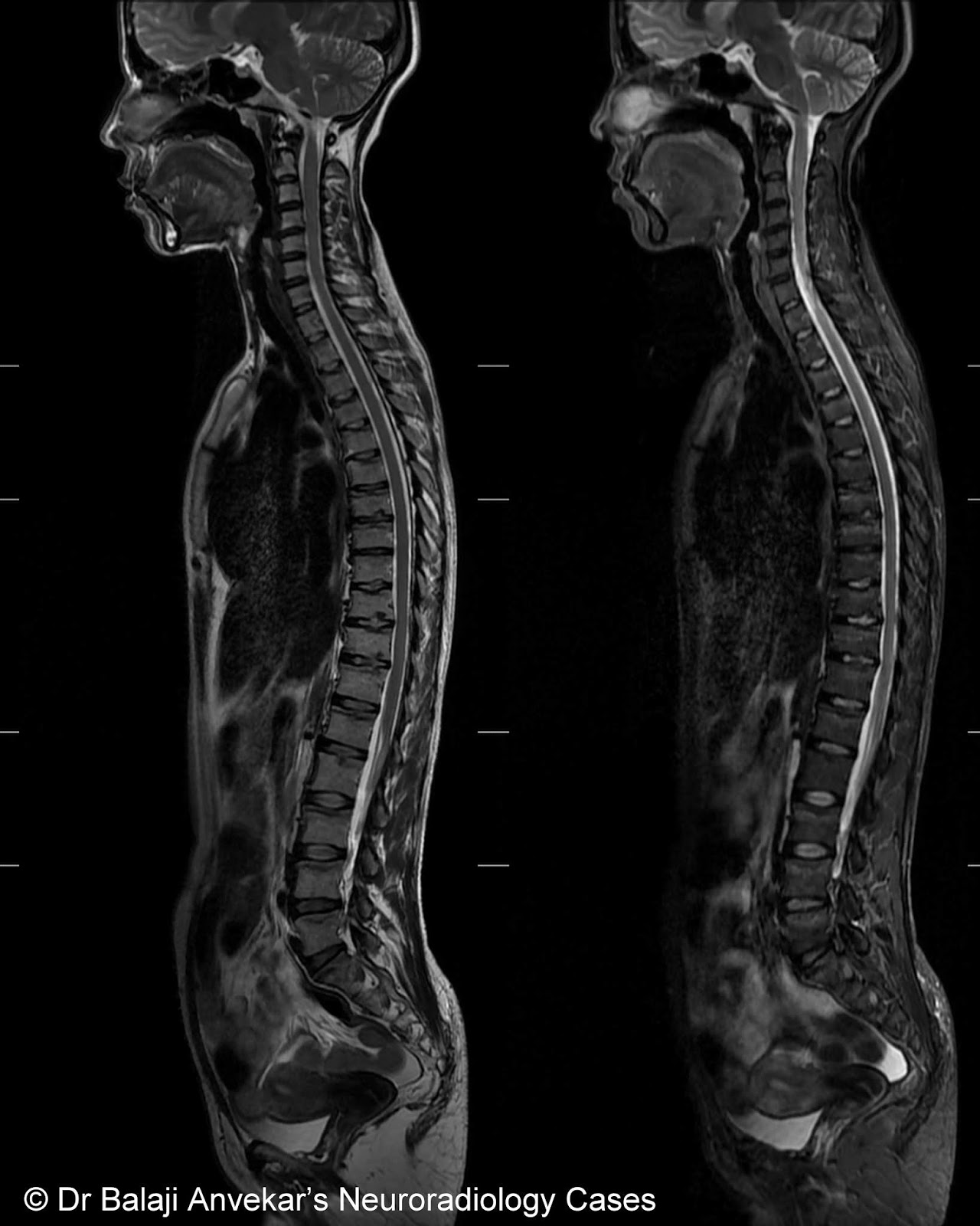 Dr Balaji Anvekar's Neuroradiology Cases