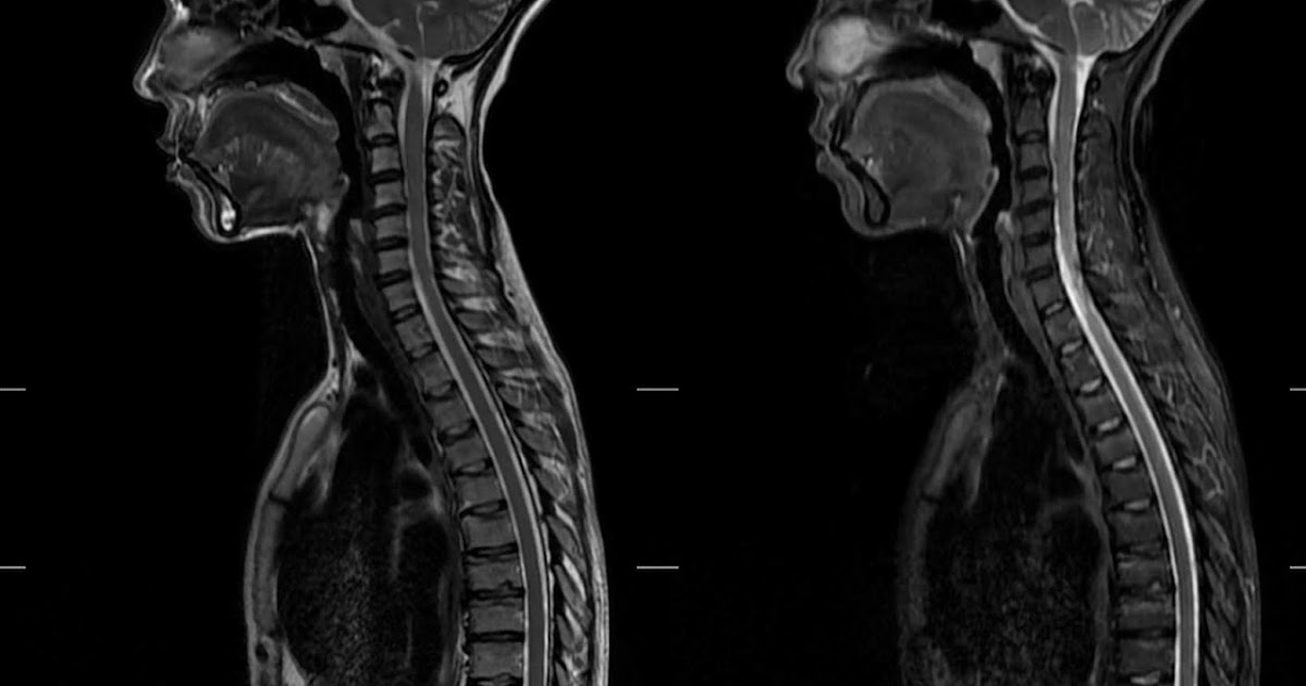 Dr Balaji Anvekar FRCR: Sickle Cell Anemia MRI