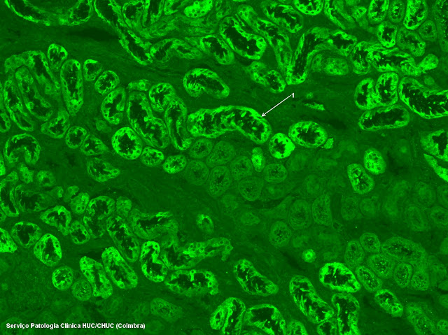 Anticorpos anti - LKM1