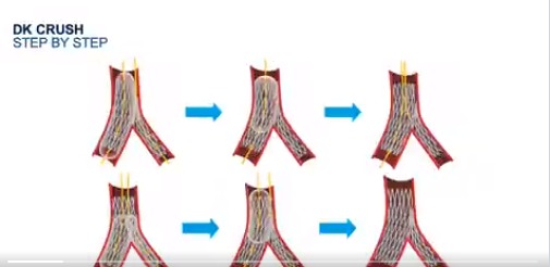 HealthforHeart: 11 steps of DK crush