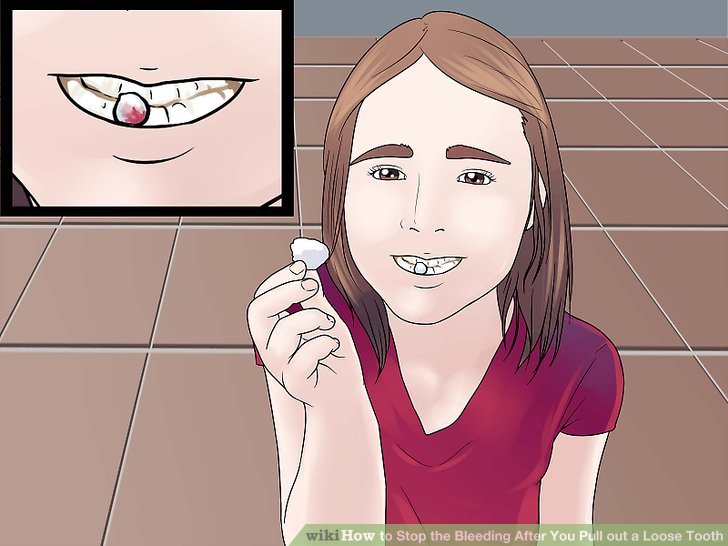 Stop the Bleeding After You Pull out a Loose Tooth