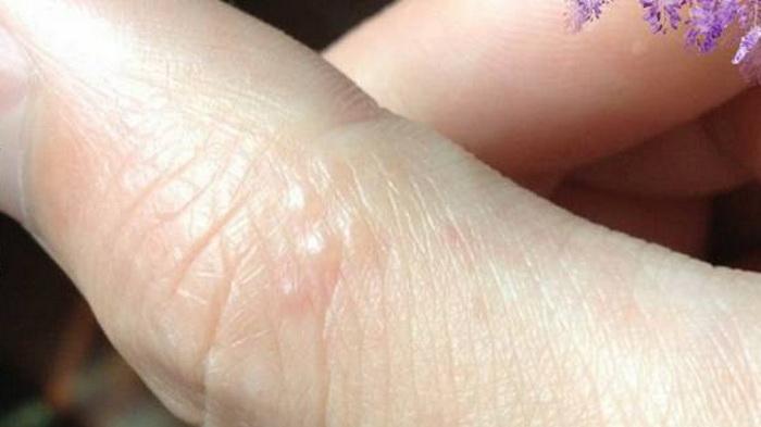 JANGAN ABAIKAN JIKA ANDA SERING MELIIHAT BINTIK-BINTIK AIR DI JARI ...