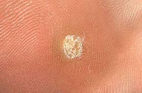 Sfaturi Utile: Sfaturi pentru combaterea negilor