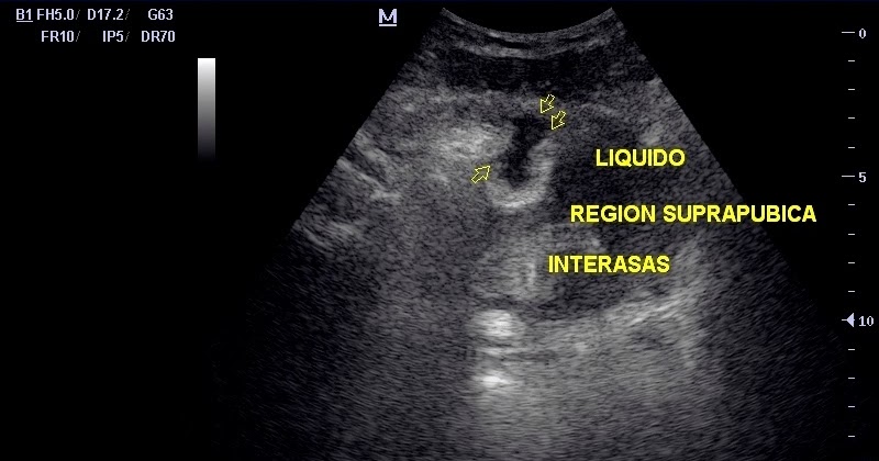 Apendicitis Perforada