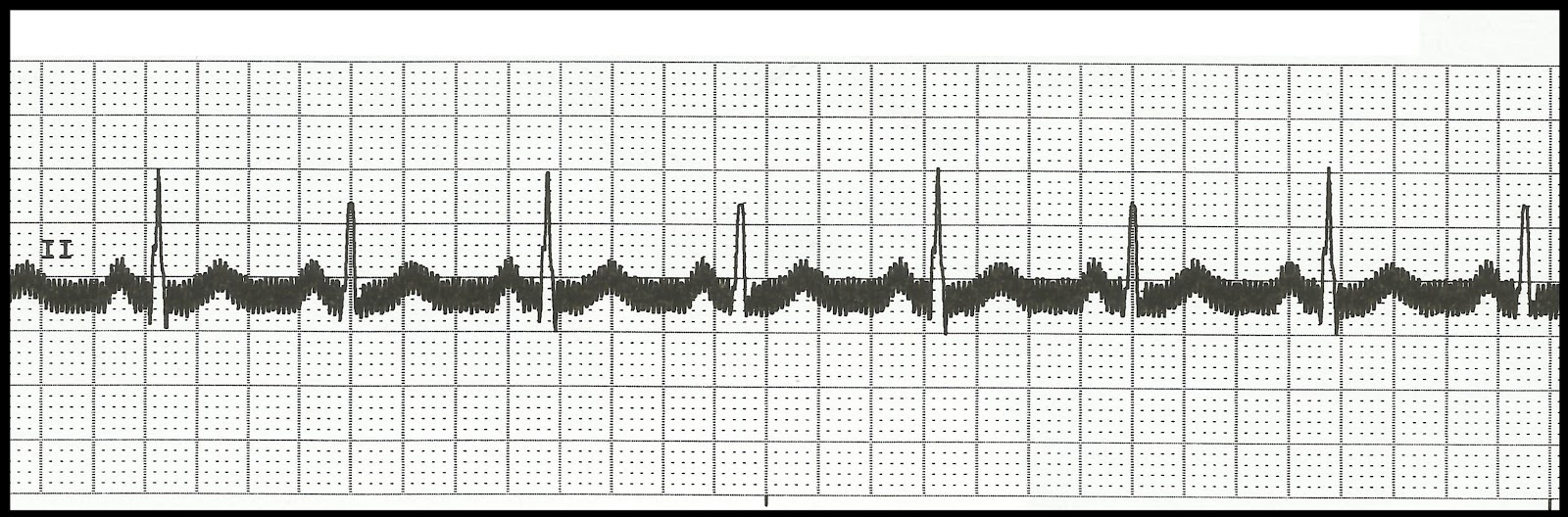 Basic EKG Rhythm Test 04