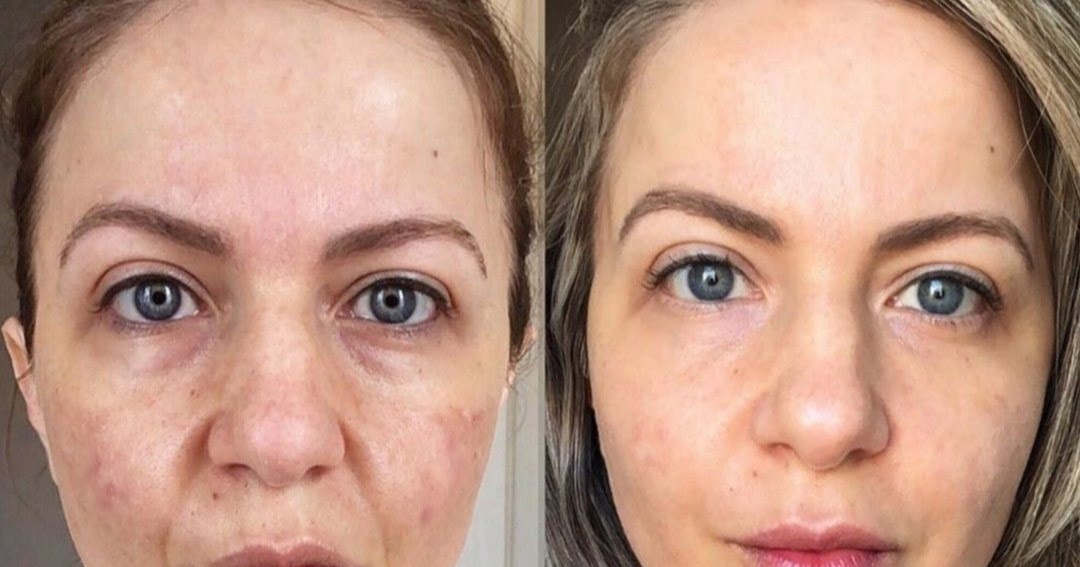 Comment enlever le mélasma (taches brunes) avec des remèdes naturels et ...