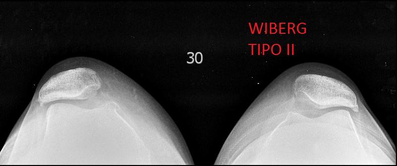 O R T O C R I T I C A: Inestabilidad rotuliana bilateral