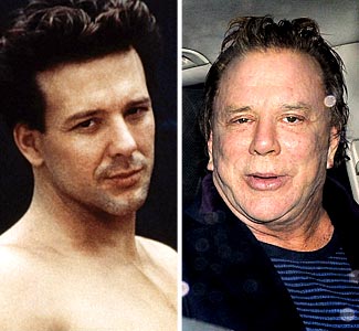 Mickey Rourke Plastic Surgery